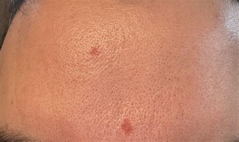 How Long For A Scab On My Face To Heal R30plusskincare