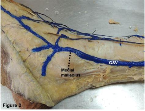 Great Saphenous Vein Cadaver