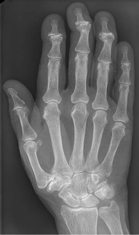 Dip Joint Arthritis Orthovellum
