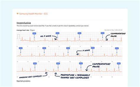Atrial Trigeminy Vs Ventricular Trigeminy On Your Watch Ecg Qaly