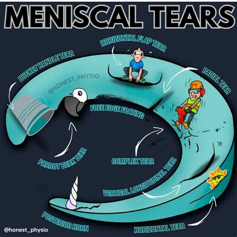Navigating Meniscal Injuries A Comprehensive Guide To Understanding Avoiding And Managing