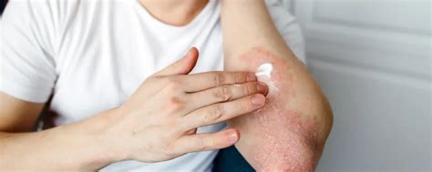 Psoriasis Light Therapy Nb Uvb Vs Puva Dermatology