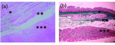 Microscopic Findings In The Dissected Margin Of The Esophagus Along The