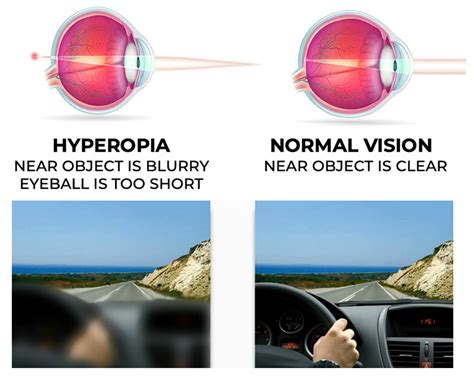 Hyperopia Farsightedness Causes And Treatment All About Your Health