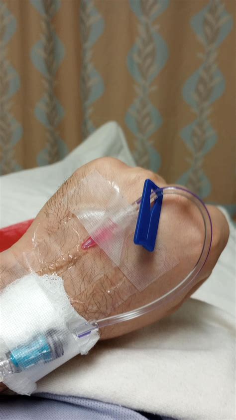 Right Side Inguinal Surgery In Just A Few Minutes Rhernia