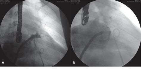 Figure 1 From Percutaneous Occlusion Of The Left Atrial Appendage With
