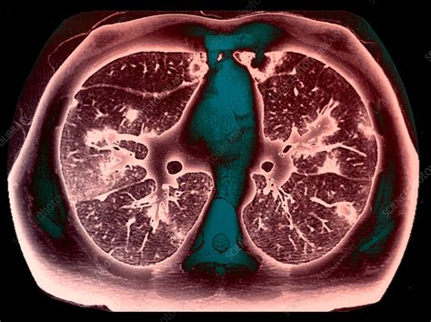 Lung Cancer Ct Scan Stock Image C0577975 Science Photo Library