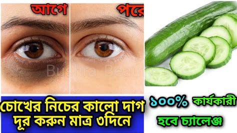 মাত্র ৩দিনে শসা দিয়ে চোখের নিচের কালো দাগ দূর করুন ডার্ক সার্কেল দূর