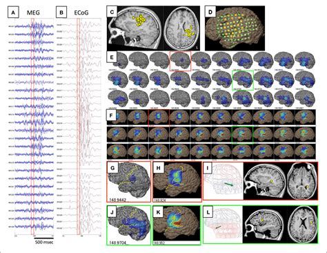 Figure 1 From Spatiotemporal Accuracy Of Gradient Magnetic Field Topography Gmft Confirmed By