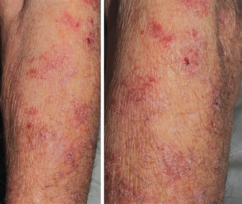 Rash On Arms