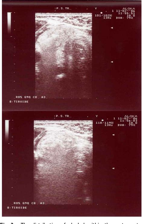 Figure 1 From A 7 Year Follow Up Of Patients With Thyroid Cysts And Pseudocysts Treated With