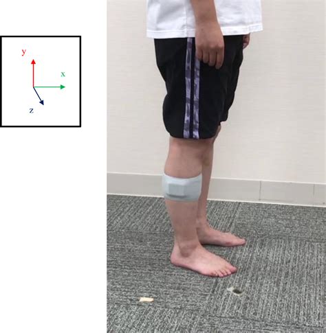 Figure 3 From Temporary Meniscus Extrusion Is Caused By Cumulative