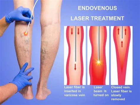 Laser Treatment For Varicose Veins Fast And Effective Relief