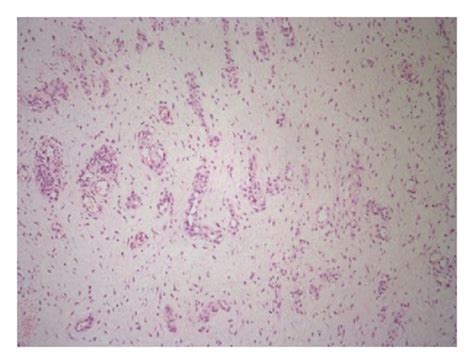 Histopathologic Examination Of The Tumor A Spindled And Download Scientific Diagram