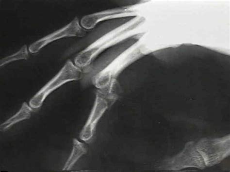 Volar Pip Dislocation Wheeless Textbook Of Orthopaedics