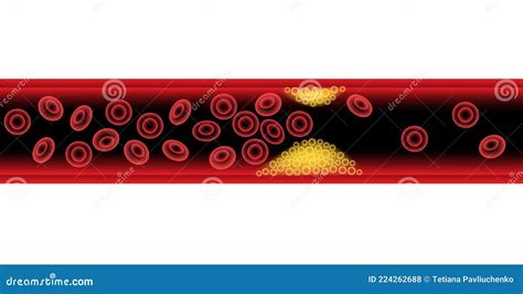 Cholesterin Und Atherosklerose Vektor Abbildung Illustration Von