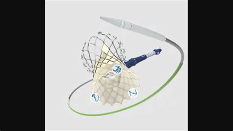 Medtronic Receives Ce Mark Approval For Evolut Fx Tavr System