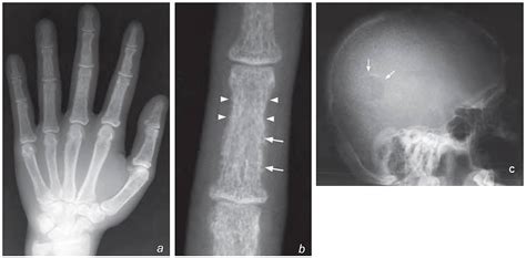 Patient With Lethargy Polydipsia And Polyuria Manual Of Medicine