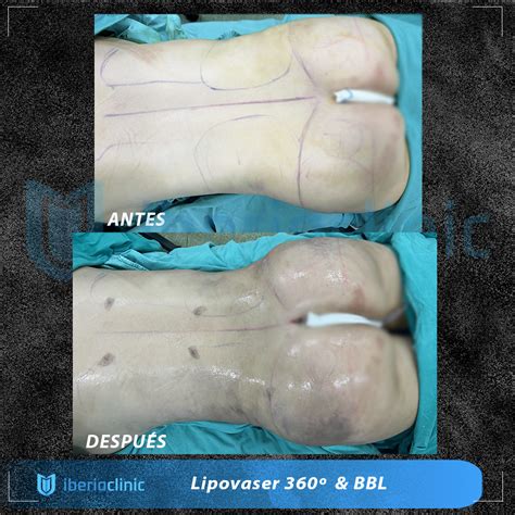 Liposucción Cirugía Estética İberia Clinic