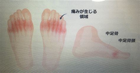 足の指の付け根が痛い シューイチランナー三毛猫