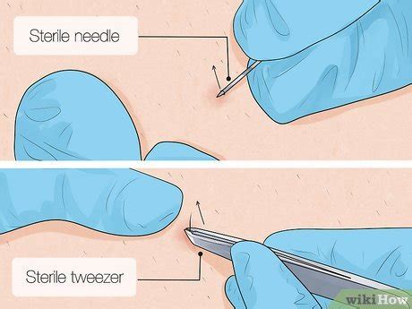 Can You Pull Out An Ingrown Hair