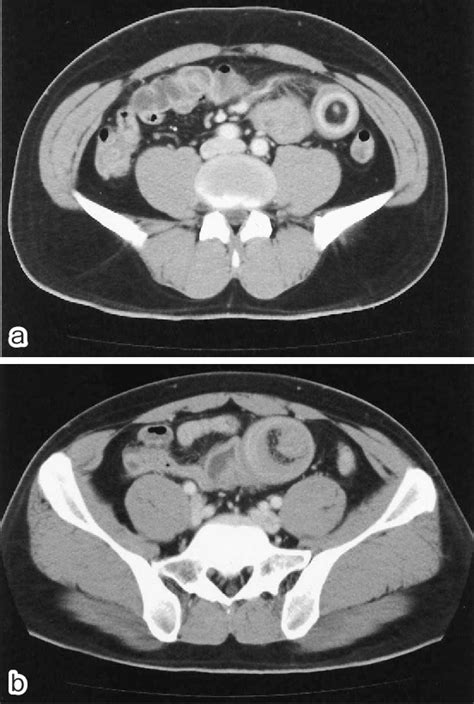 Figure 1 From A Case Of Intussusception Due To Inverted Meckels Diverticulum With Lipoma