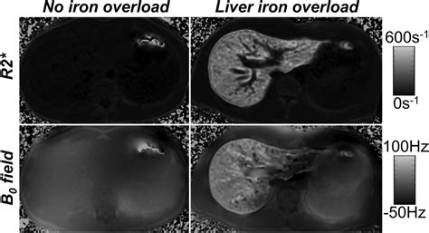 Liver Iron Quantification Mri Radiology At Deborah Mcgee Blog
