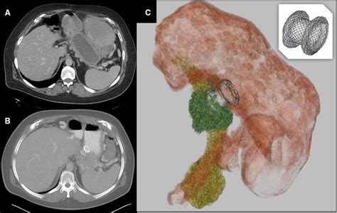 The Axios Lams Positioned Between The Stomach And Lesser Sac Walled Off Download Scientific