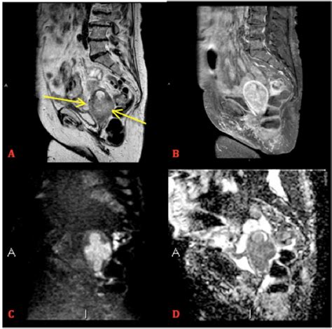 Figure 10 From Uterine Sarcoma Subtypes And Their Differentiation From