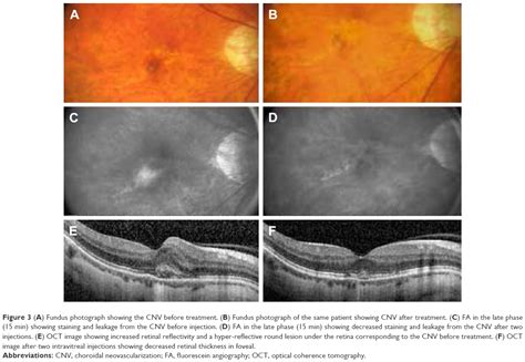 Intravitreal Aflibercept For The Treatment Of Choroidal Neovasculariza