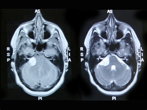 Retrosigmoid Approach 3d Atlas Of Neurological Surgery