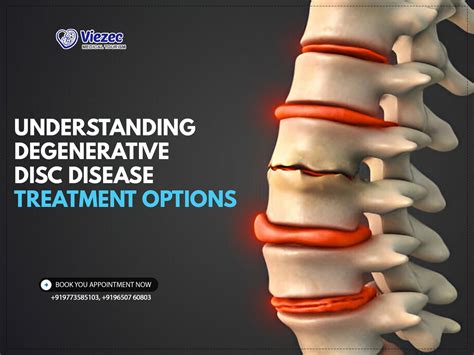 Degenerative Disc Disease Explained Treatment Choices