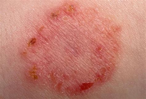 Erupção Cutânea Vermelha E Pruriginosa Retoedu