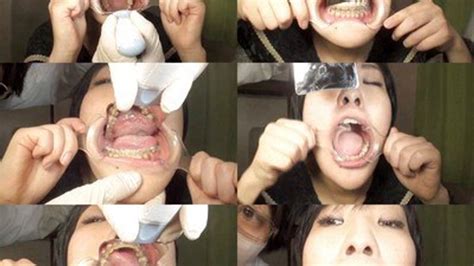 Removing Braces 101 Part 4 High Resolution Avi Format Deviant Dentist Mouth Fetish Mania