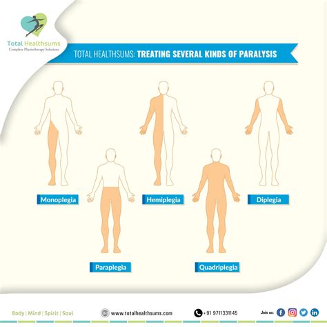 Paraplegia Definition Causes Symptoms Types Treatment 49 Off