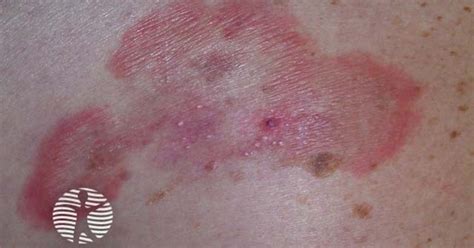 Vasculitis Image