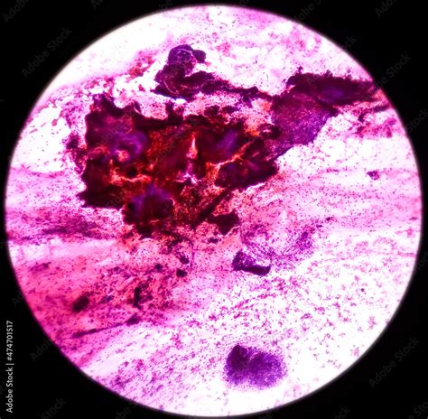 Foto De High Grade Squamous Intraepithelial Lesionhsil