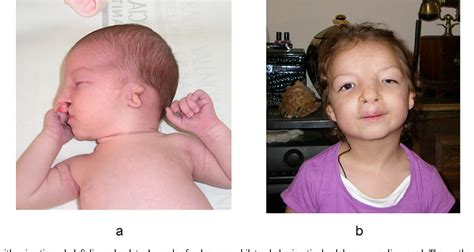 Figure 2 From Mycophenolate Mofetil Embryopathy A Newly Recognized