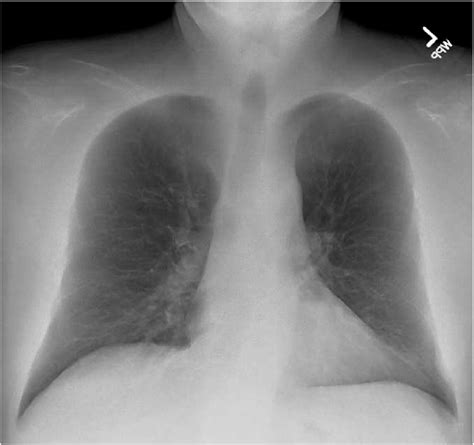 Chest X Ray Posteroanterior View Mild Bronchial Wall Thickening Download Scientific Diagram