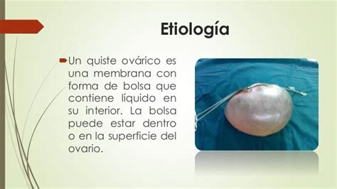 Quiste De Ovario