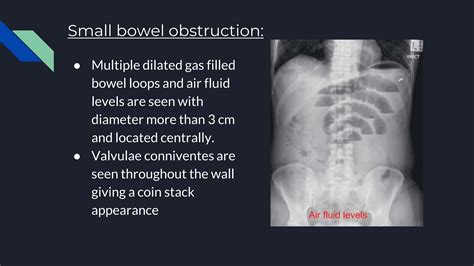 Approach To X Ray Abdomen And Kubpptx