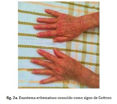 Síndrome De Superposición De Dermatomiositis Y Lupus Eritematoso