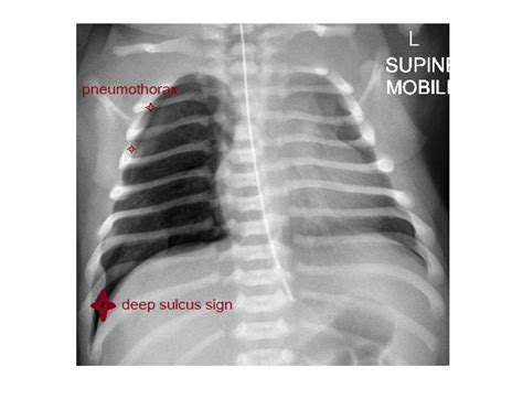 Deep Sulcus Sign Emergency Medicine Journal