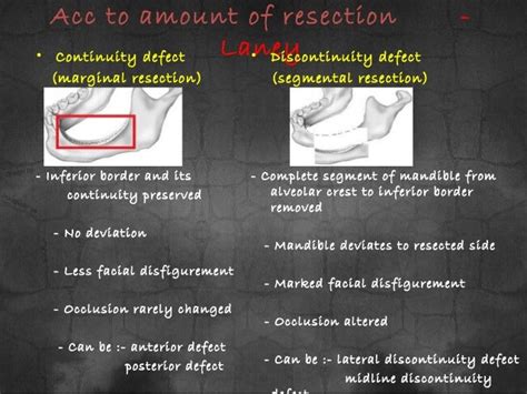 Prosthodontic Management Of Mandibular Defects