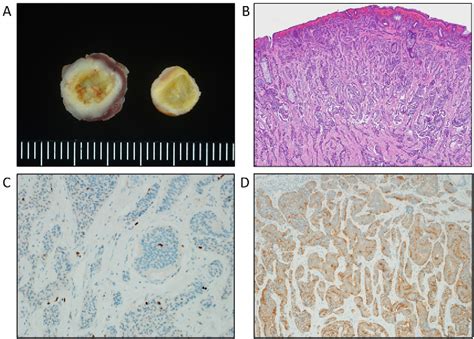 Figure 2 From Indications For Lateral Lymph Node Dissection In Patients With Rectal