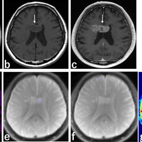 Mri From A 75 Year Old Woman With Pcnsl A T2 Weighted Sequence Axial Download Scientific