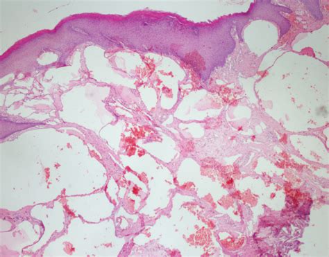 Lymphangioma Histology Diagram