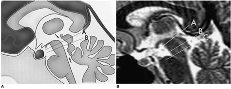 A Normal Anatomy Of The Cerebral Aqueduct As Viewed In The Sagittal