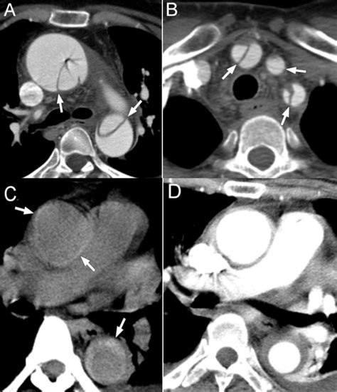 Dissection Type A Classic Type A Aortic Dissection With Visible Download Scientific Diagram