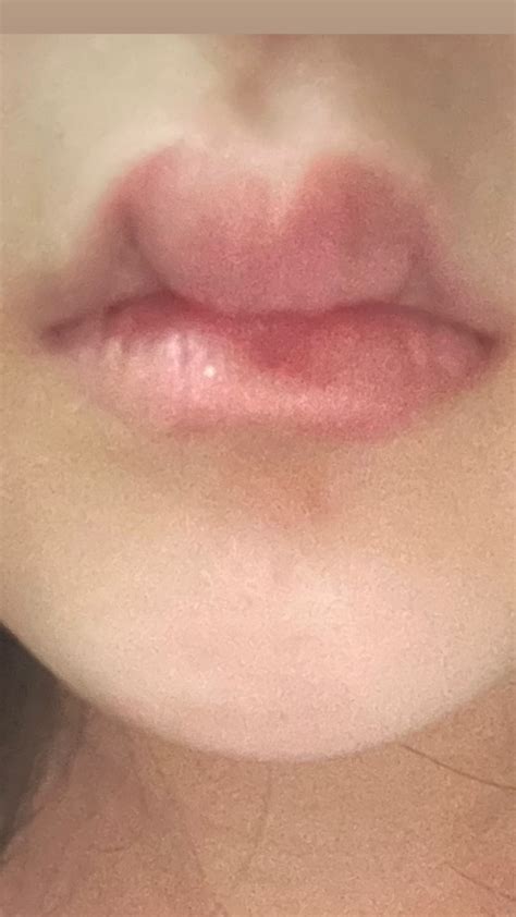 입술 부움 부음 지식in